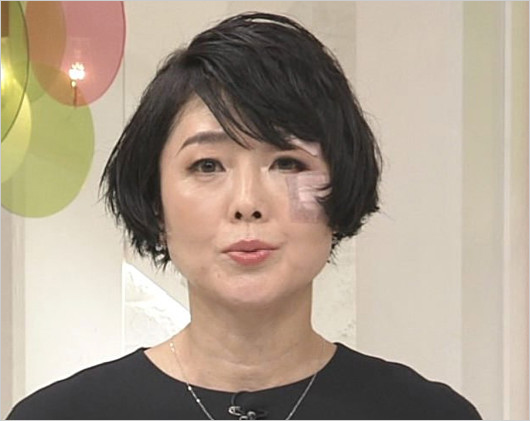 有働由美子アナが顔面大ケガの原因は…news Zero降板発表後に衝撃姿、飲酒トラブルや殴られた疑惑も。画像あり 今日の最新芸能ゴシップ